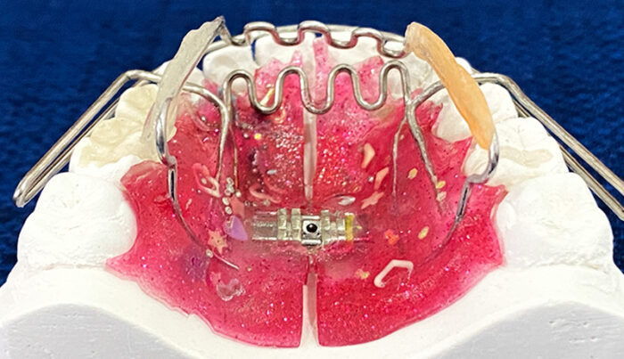 CEDHUM - Centro Educativo de Humanidades | ¿Cuál es la utilidad del aparato ortopédico SN3 del ...